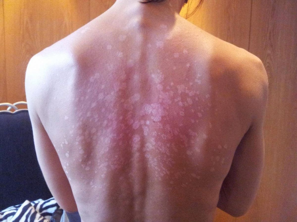 5 Cara Mengobati Panu dengan Cepat dan Aman di Rumah